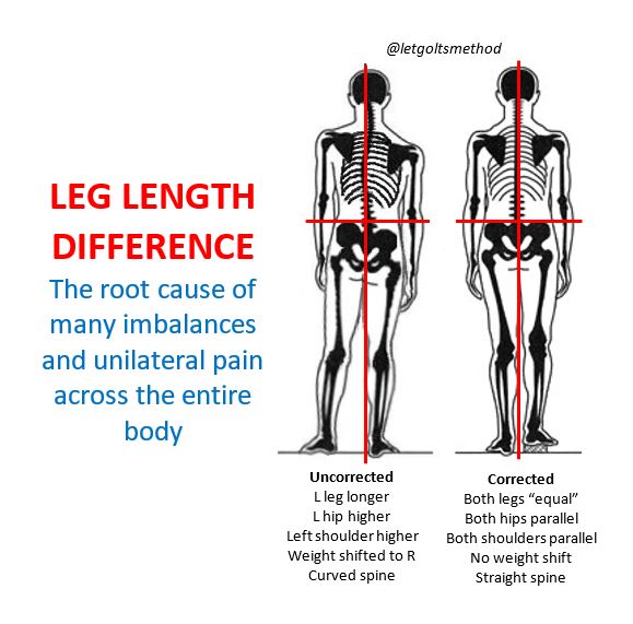 Leg Length Difference Discrepancy Leg Length Difference Discrepancy